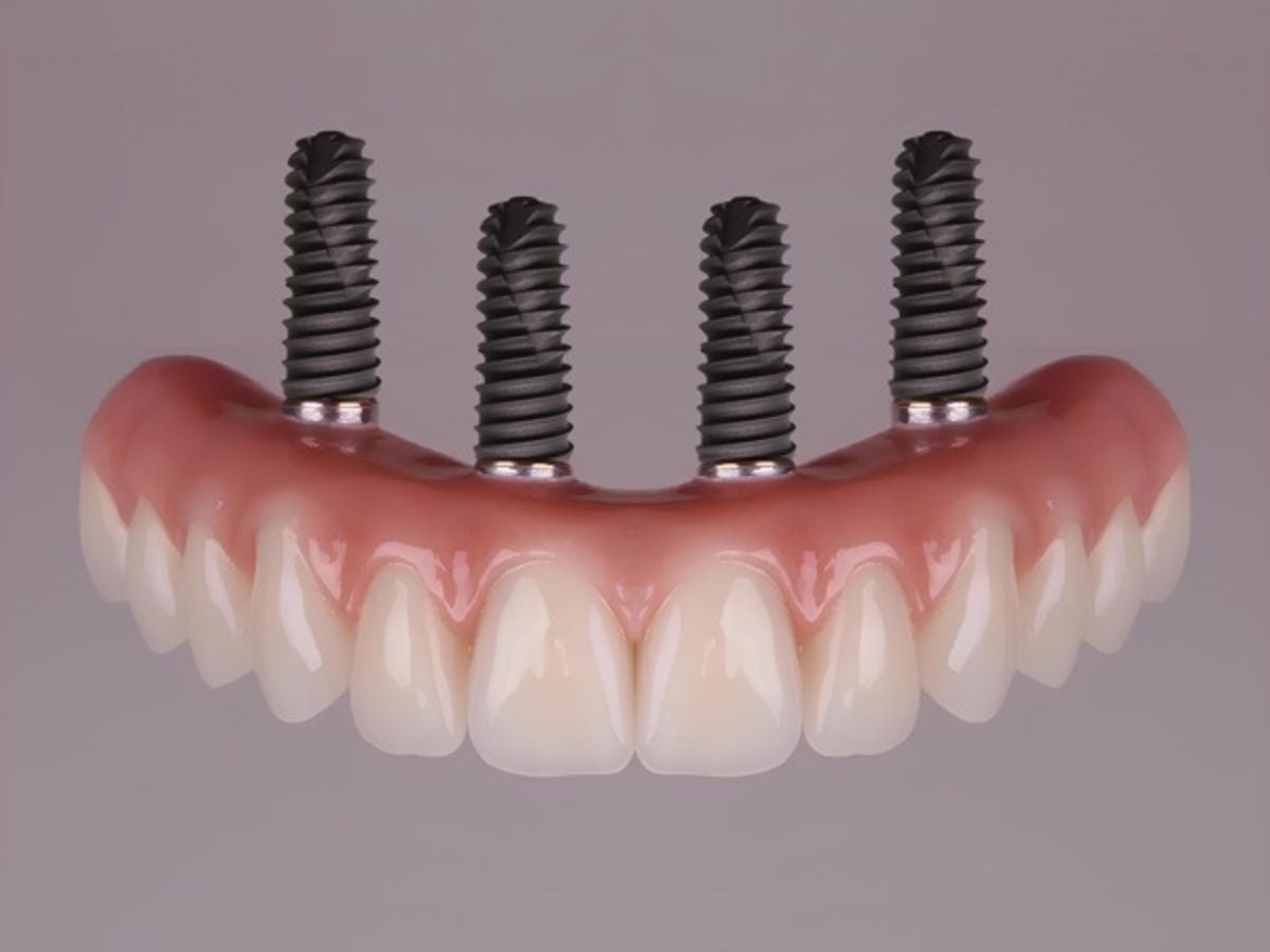 Can Full Mouth Dental Implants Be Done In One Day? - Restore in 24